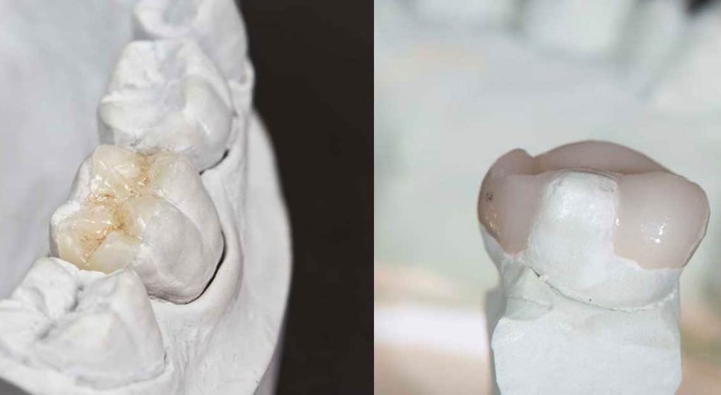 Inlays & Onlays – Oxford Dental
